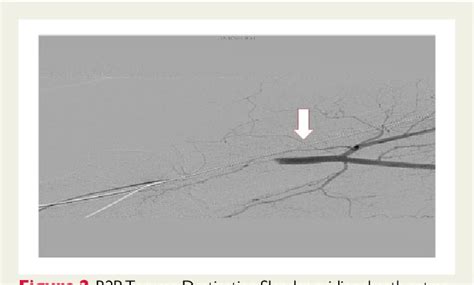 Figure 2 From Severe Radial Artery Spasm Causing Entrapment Of The