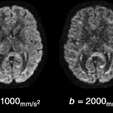 Diffusion signal depends on b value We see b ¼ S image and b ¼ Download Scientific