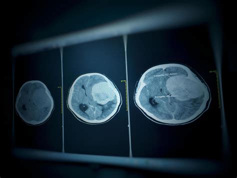 Ct Brain Seven Cm Diameter Hyperdensity Mass With Lobulated Surface At Extra Axial Lateral To