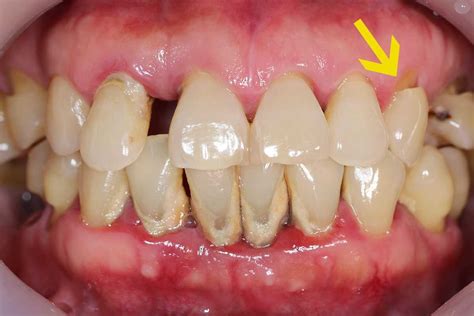 White Line On Gums