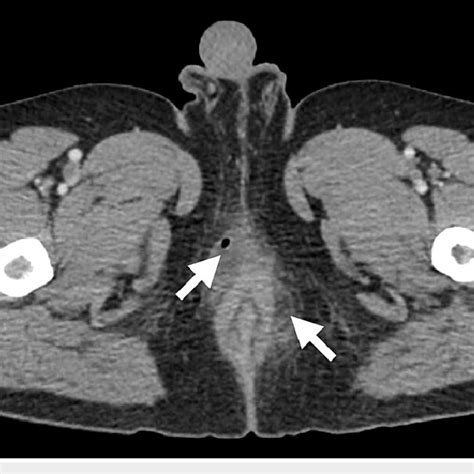 Ct Image Of The Perianal Abscesses In The Right Anterior And Left