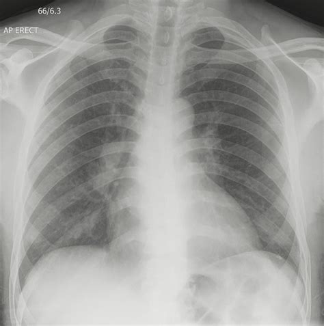 A Diffuse Fine Papular And Pustular Rash In A Man With Advanced Human Immunodeficiency Virus And