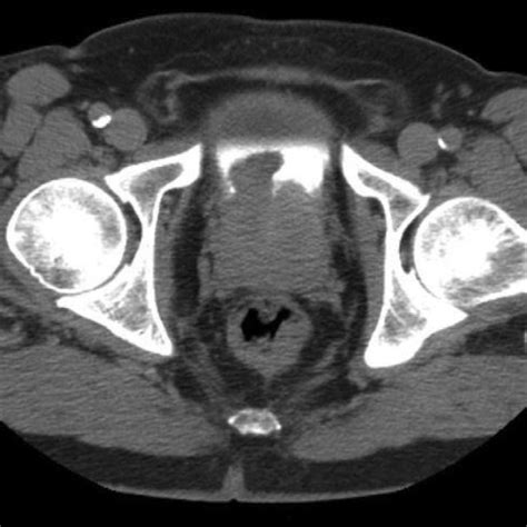Two Years After Turbt And Subsequent Initiation Intravesical Bcg