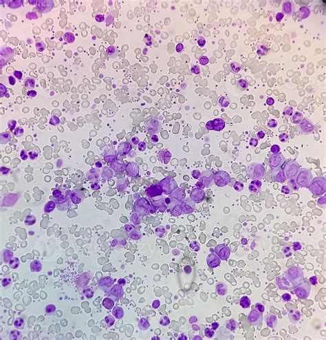 Eessential Thrombocytosis Blood Smear Showing Abnormal High Volume Of