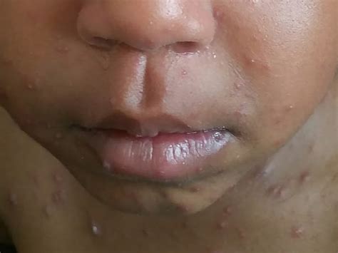 Scabies Rash On Face