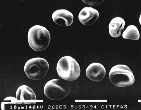 AMIGOS PARA SIEMPRE MORFOLOGÍA ANORMAL DE LOS ERITROCITOS