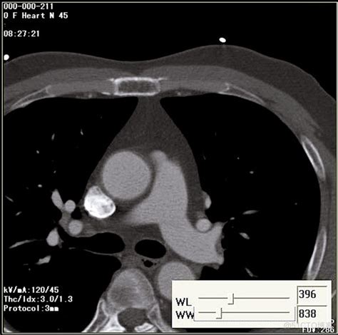 三维重建之虚拟内窥镜(ve)是什么?怎么实现?编程编程的技术博客51cto博客 三维重建之虚拟内窥镜(ve)是什么?怎么实现?编程编程的技术博客51cto博客
