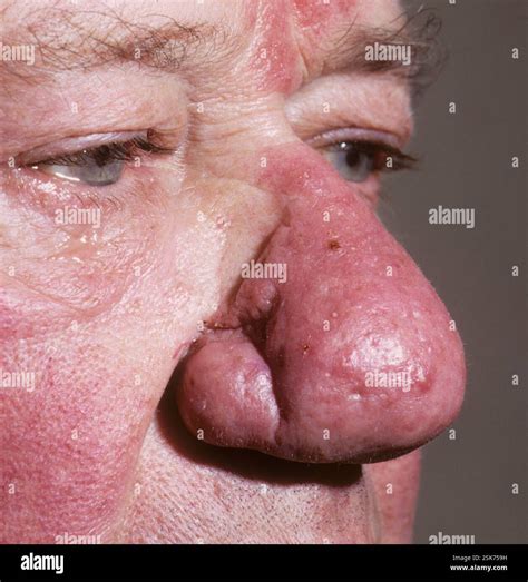 Rhinophyma Close Up Of The Bulbous And Reddened Nose Of A 79 Year Old
