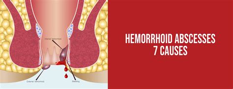 Hemorrhoid Abscess 9 Symptoms 7 Causes And 6 Risk Factors