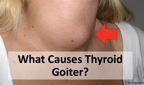 Thyroid Goiter Heres What Caused It And How To Stop It From Growing Dr Hagmeyer