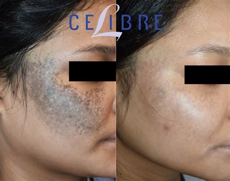 Nevus Of Ota Birthmark Laser Removal Celibre Medical