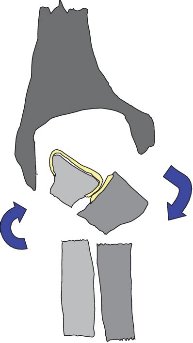 Figure 2 From The Proximal Radio Ulnar Joint Pruj Plasty For The Lost