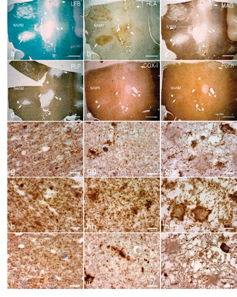 Figure 2 From Mitochondrial Defects In Acute Multiple Sclerosis Lesions Semantic Scholar
