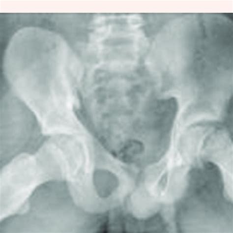 Exophthalmoses In Graves Disease Figure 2 Radiograph Showing Left