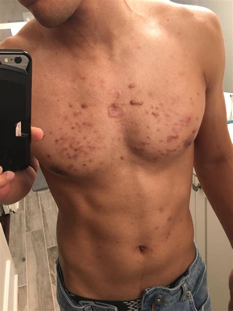 Acne Keloid Scars Before And After At Leigh Davis Blog