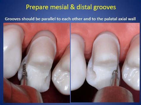 Lab Simulations 3 4 Gold Crown Prep Upper 1st Premolar