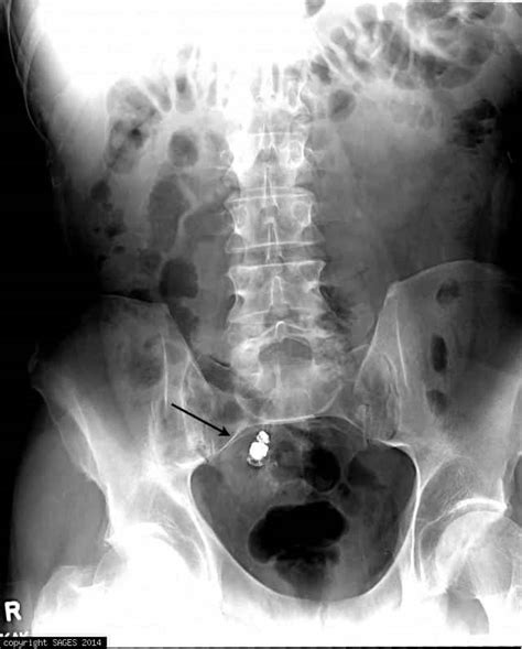 Pillcam Get Stuck Sages Image Library