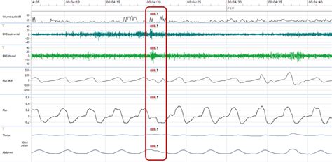 Capture Of A Swallowing Act In Patient Id3 At Time 1 00 04 20