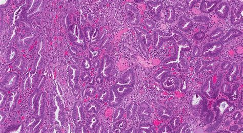 Your Pathology Report For Adenocarcinoma Of The Cervix Mypathologyreport