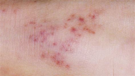 Viral Meningitis Causes Treatment And Prevention