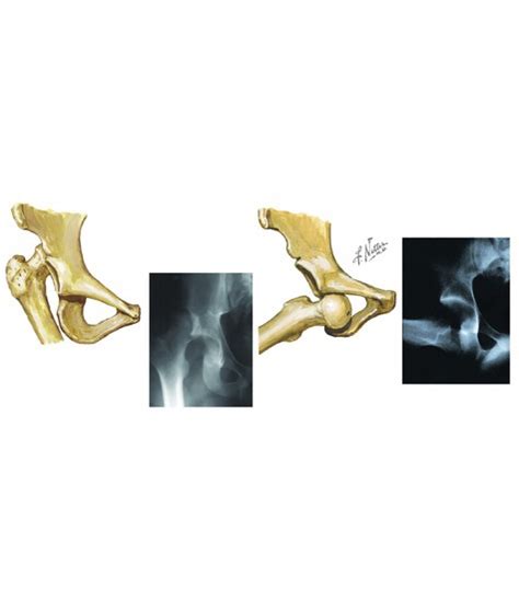 Dislocation Of The Hip