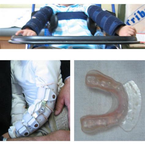 Management Of Self Injurious Behaviour The Cornerstone Of Day To Day Download Scientific