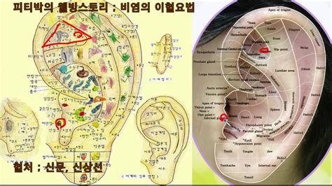 이침활석요법강좌임상 비염의 이침요법 Youtube