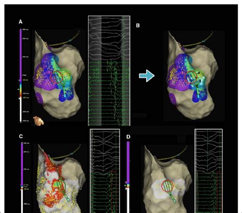 Ablation Strategy A Ventricular Tachycardia Vt Activation Map Download Scientific Diagram