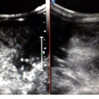 Female 45 Years US Image Shows During RFA Procedure The Straight Download Scientific Diagram