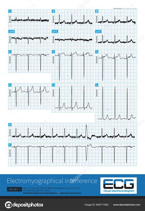 Baseline Ecg Interfered Its Own External Electrical Signal Affect Shape