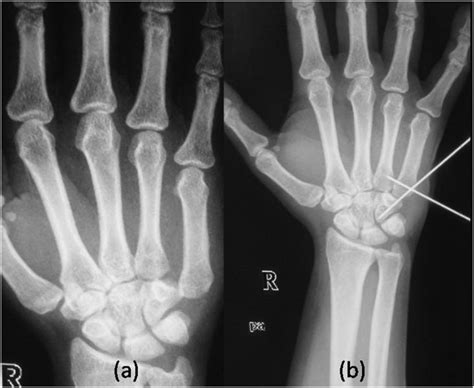 Metacarpal Shaft Fracture