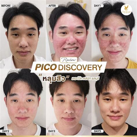 Pico Discovery คืนผิวเรียบเนียนใส ไร้ริ้วรอย ในชลบุรี