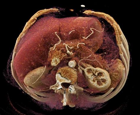 Duodenal Gist Tumor Looks Like Pancreatic Neuroendocrine Tumor Pnet
