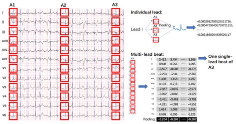 Automatic Arrhythmia Detection With Multi Lead Ecg Signals Based On
