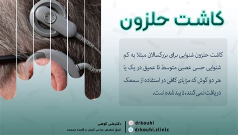 کاشت حلزون گوش چیست؟ کلینیک گوش دکتر کوهی