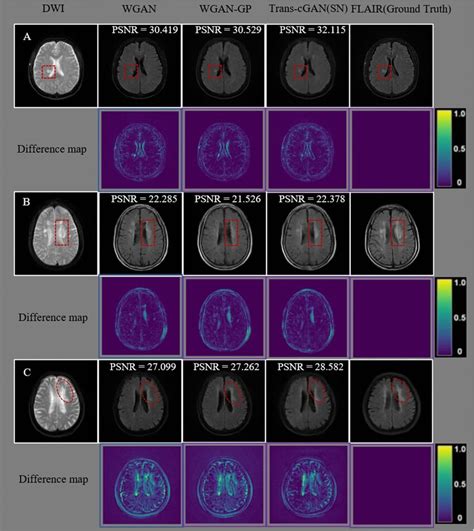 Comparison Of Flair Like Image Synthesis Results Based On Different