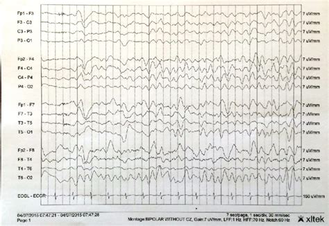 Repeat Electroencephalogram Of The Patient Download Scientific Diagram