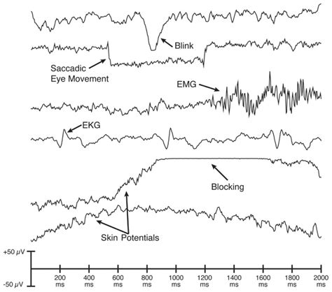 Examples Of Single Trial Waveforms Showing Common Artifacts Each