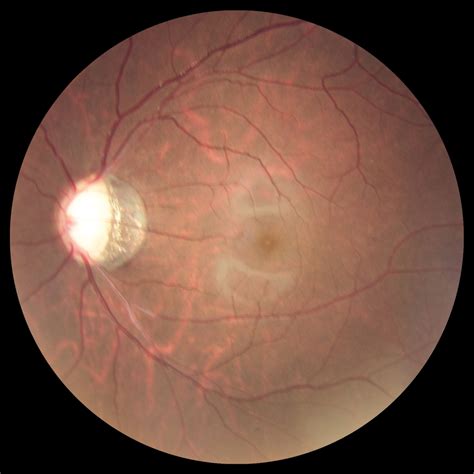 pamixsun swinv2 tiny for glaucoma classification at main