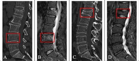 Spinal Compression Fractures A Comprehensive Overview R Orthopedicsurgery
