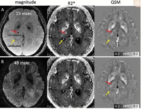 Quantitative Susceptibility Mapping For Measuring Paramagnetic Download Scientific Diagram