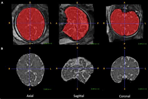 Frontiers Semi Automatic Segmentation Of The Fetal Brain From Magnetic Resonance Imaging