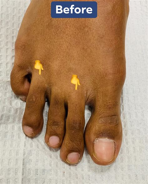 Jaws Podiatry 💟 Minimally Invasive Bilateral