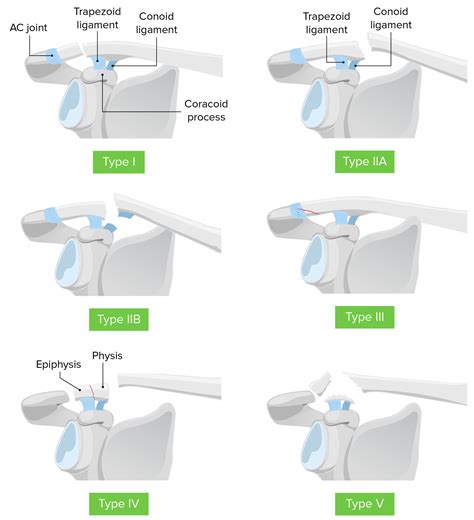 Clavicle Fracture Classification Upper Limb Injuries Emergency Care
