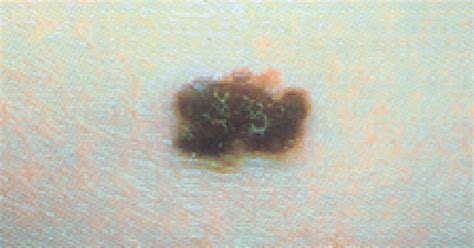 수술로도 치료 실패한 ‘악성 흑색종 피부암 환자에 ‘이 약 효과