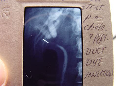 Biliary Stricture 1577 Bile Duct Stricture After Cholecystectomy 3