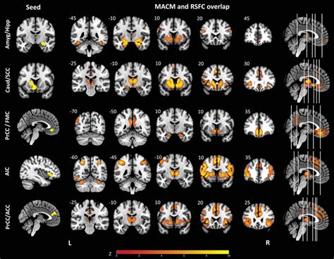 The Overlap Of Resting‐state Functional Connectivity And Meta‐analytic