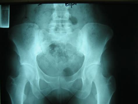 Radiografía De La Articulación Sacroilíaca Normal