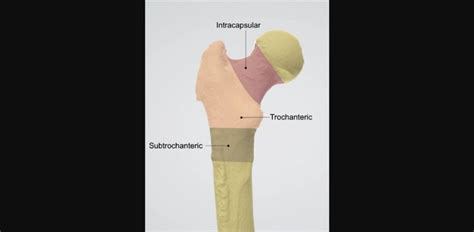 Convolutional Neural Networks Support Better Patient Outcomes In Hip