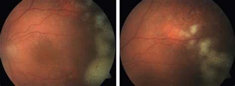 Neoplastic Masqueraders Of Uveitis Retina Today